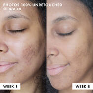 What Does Salicylic Acid Do for the Skin? | Vichy Mag